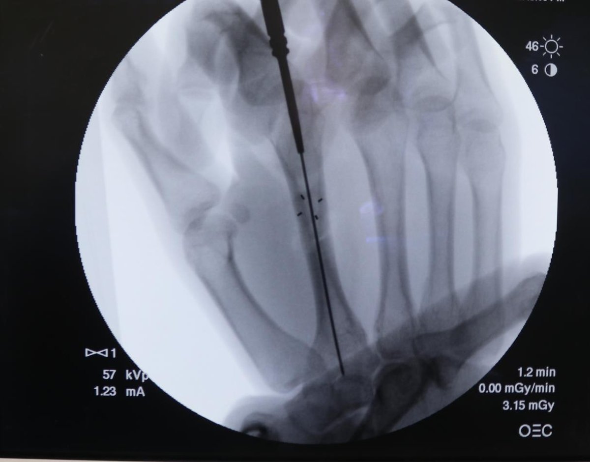Use of NX Nail for oblique fracture fixation of 2nd metacarpal